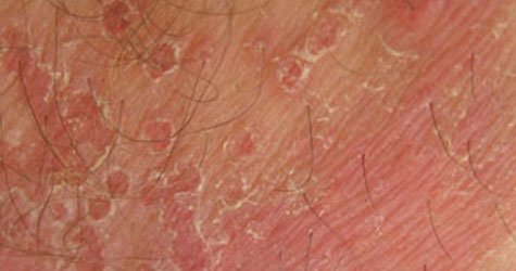 Best skin doctor in Delhi for all skin and hair diseases,skin allergies